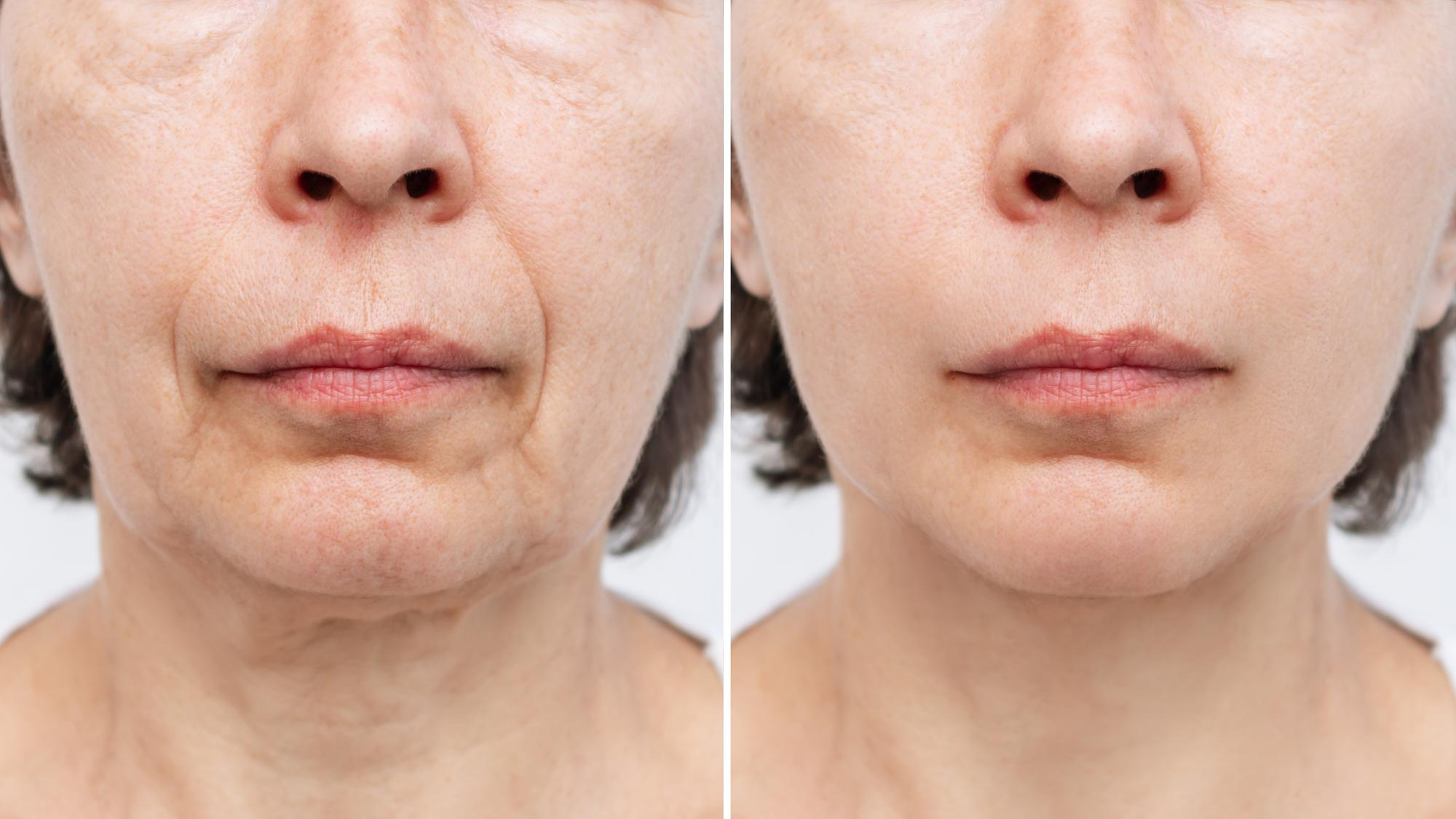 “WRINKLE RELAXER OR DERMAL FILLER? - Peter Karlsberg, MD