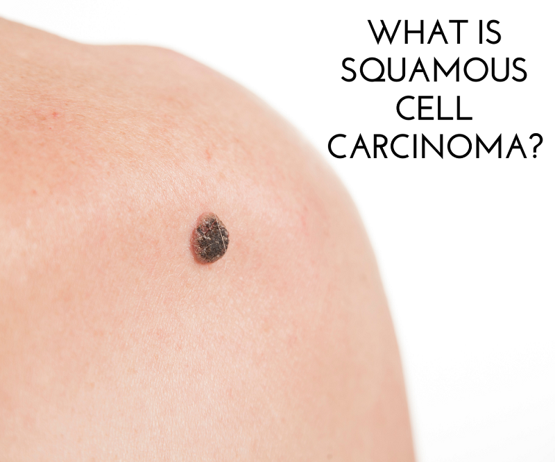 “What is Squamous Cell Carcinoma? - Peter Karlsberg, MD