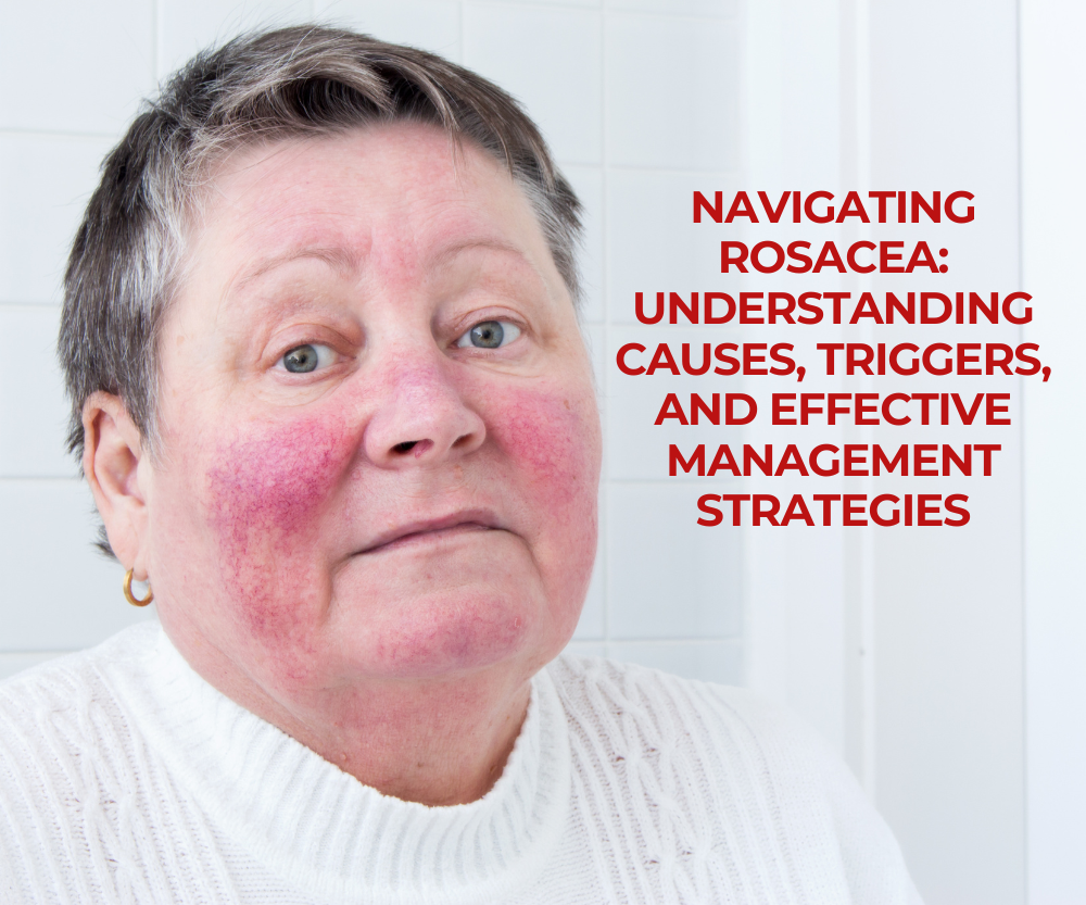 “Navigating Rosacea: Understanding Causes, Triggers, and Effective ...